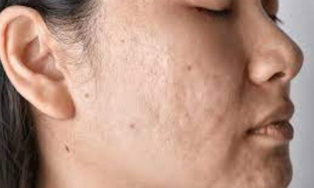 Deep vs Shallow Scars: Treatment Approaches Used in Singapore